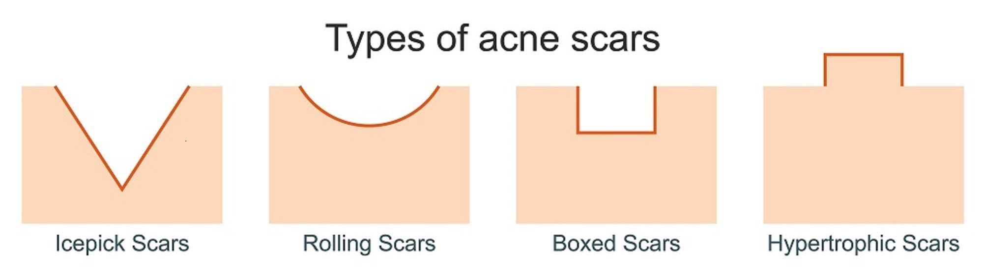 Acne Scarring | Craig Singer MD Dermatology