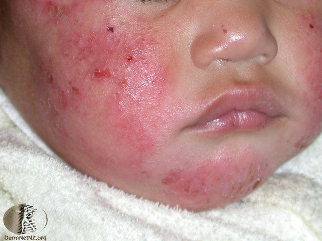 Eczema | Craig Singer MD Dermatology