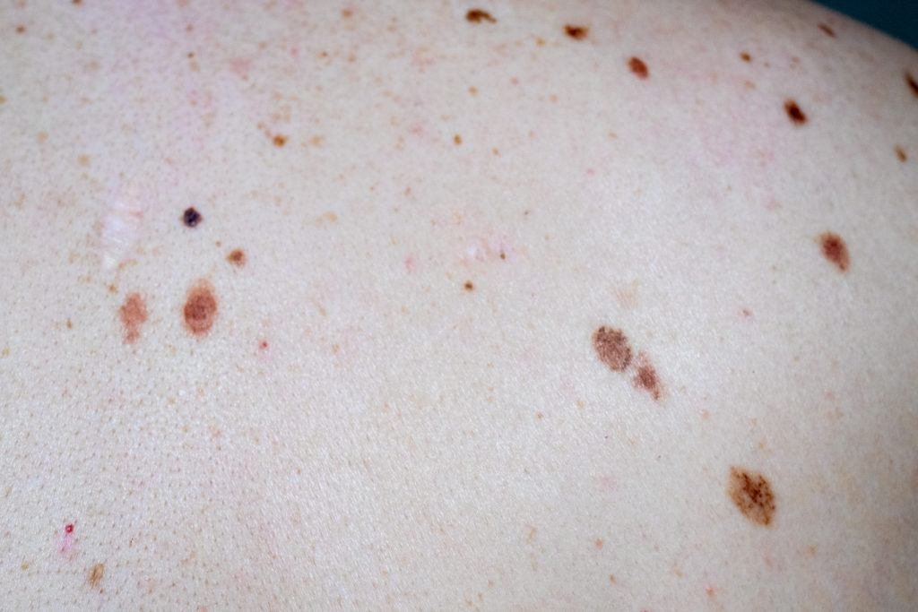 Moles | Craig Singer MD Dermatology