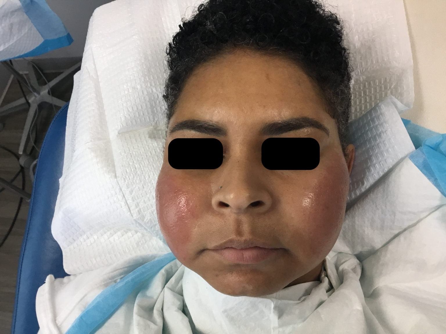 Subcision | Craig Singer MD Dermatology