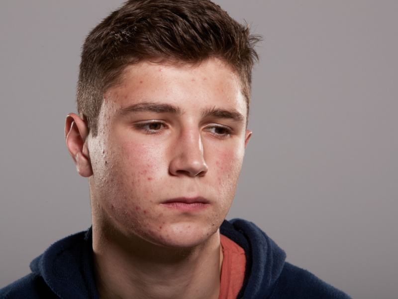 A dietary supplement can improve Acne Excoriée (skin picking in acne ...