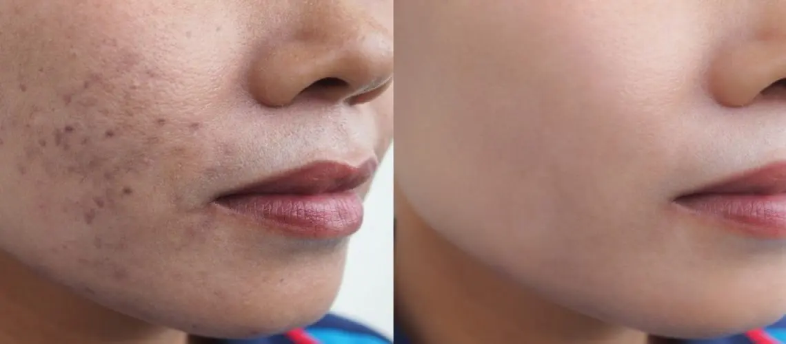 Melasma | Craig Singer MD Dermatology
